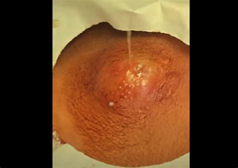 How To Tell If Abscess Is Healingtypes Of Abscess Archives New Pimple