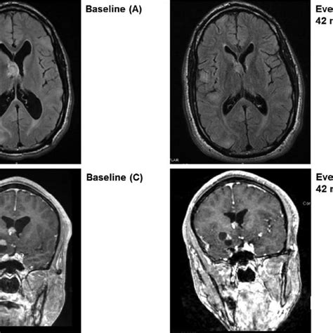 Case 4 Magnetic Resonance Imaging Of Subependymal Giant Cell