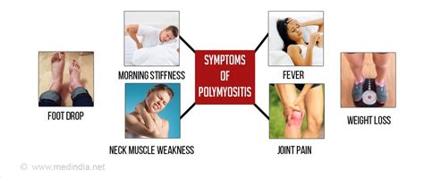 Polymyositis Types Causes Symptoms Complications Diagnosis Treatment