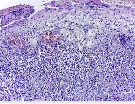 Histology Examination Hematoxylin And Eosin Stain 200× Dermal