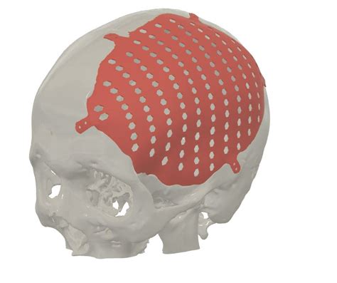 Stl File Cranial Plate Made According To Defect・3d Printable Design To Download・cults