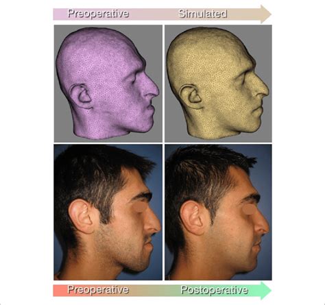 Comparison Between The Preoperative And Simulated Models And