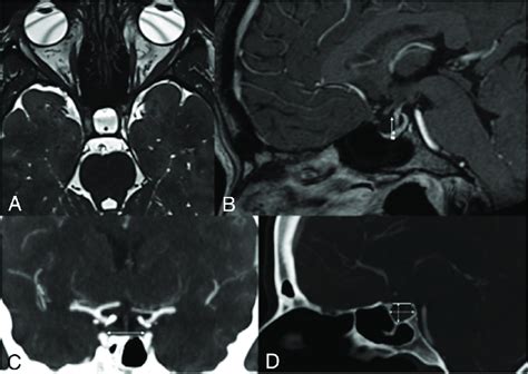 A 47 Year Old Female Patient Who Presented With Right Sided Disabling