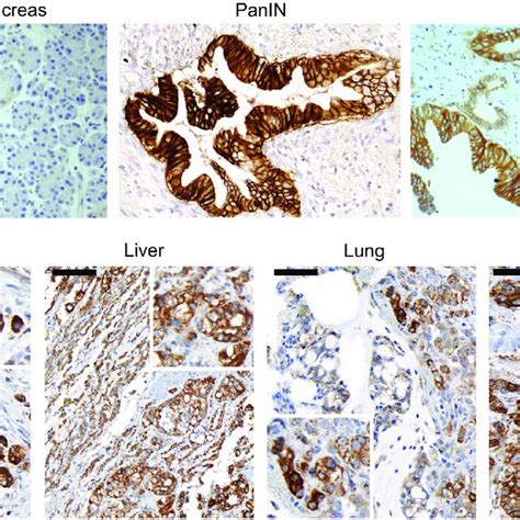 Expression Of αvβ6 Protein In Human Pdac Ffpe Pdac Tissues Were Download Scientific Diagram