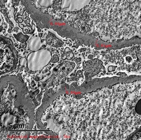 Diffuse Subepithelial Deposition Of Electron Dense Substances Electron