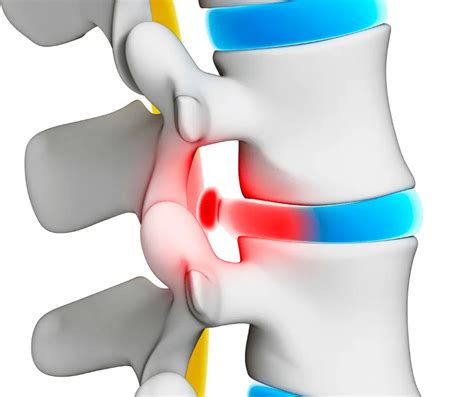Average Herniated Disc Settlement From A Car Accident In California