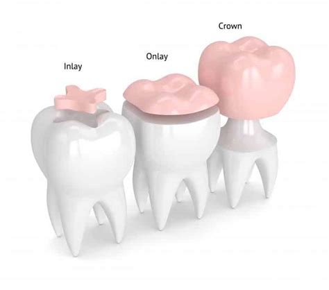 What Is A Dental Onlay Procedure At Roy Bush Blog