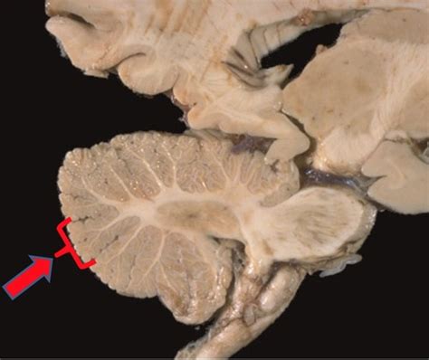Principles Of Cerebellar Disease Flashcards Quizlet