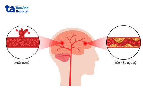 LDL Cholesterol là gì Chỉ số bình thường trong máu là bao nhiêu