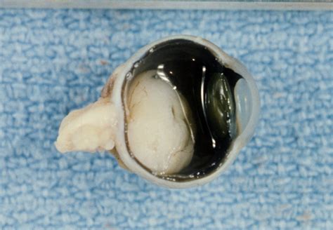 Retinoblastoma Hereditary Ocular Diseases