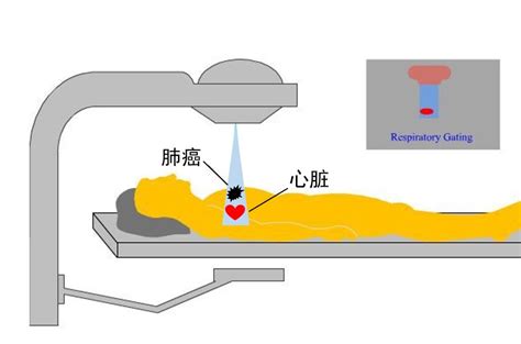 全球质子重离子治疗最新进展（上）放疗