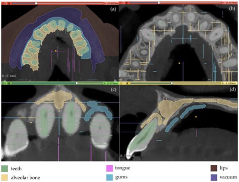 Evaluation Of 3d Modeling Workflows Using Dental Cbct Data For