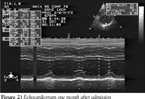 Figure 2 From Acute Reversible Left Ventricular Dysfunction Secondary To Alcohol Semantic Scholar