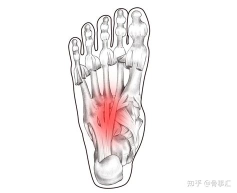 专家支招脚后跟总是疼痛，是什么原因造成的？怎么治疗？ 知乎