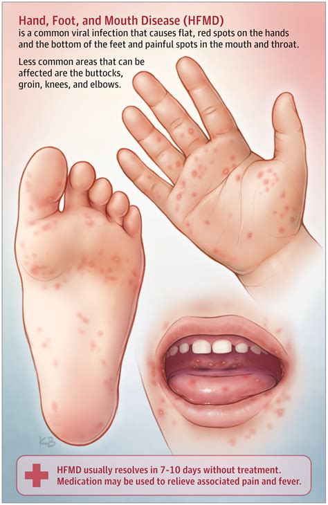 Hfmd The Symptoms Of Hfmd Hand Foot And Mouth Disease