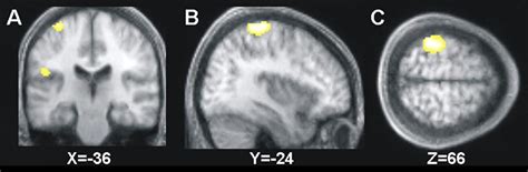 Interhemispheric Effect Of Parietal Tms On Somatosensory Response