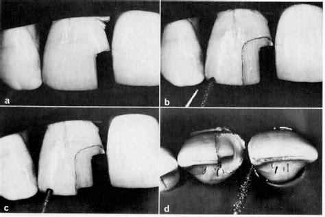 Figure 3 From Cavity Design For Class Iv Composite Resin Restorations