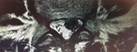 Lumbar Disk Disease Herniated Disk Johns Hopkins Medicine