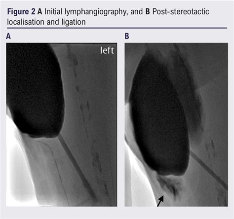 Management Of Large Post Crossover Inguinal Lymphocele Journal Of