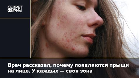 Врач рассказал почему появляются прыщи на лице У каждых — своя зона Здоровье — Секрет фирмы