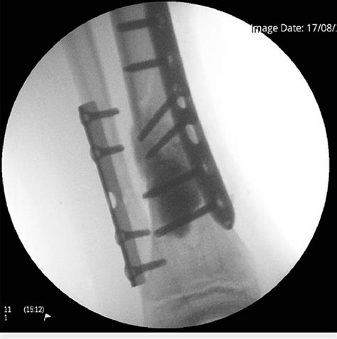 Fluoroscopy Image From Left Tibia And Fibula Orif Orif Open Reduction