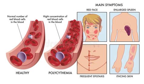Hemoglobin Stock Vector Illustration Of Carbon Anemia 23464646