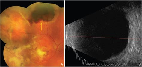 Choroidal Hemorrhage