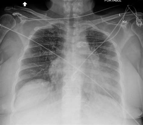 Faces Of Atelectasis Shape Lungs