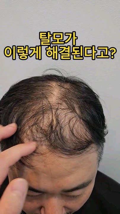 탈모엔 탈모구세주 Youtube
