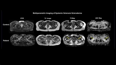 Advanced Multiparametric Magnetic Resonance Imaging Of Muscle For