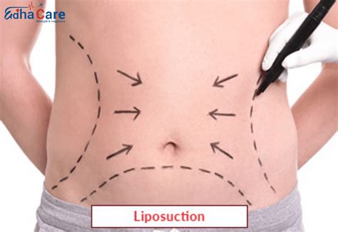 Liposuction Surgery In India Causes Symptoms Treatment