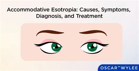 Accommodative Esotropia Causes Symptoms Diagnosis And Treatment