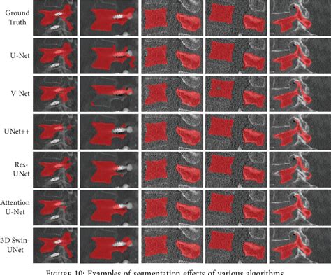 Figure 10 From A Spine Segmentation Method Under An Arbitrary Field Of