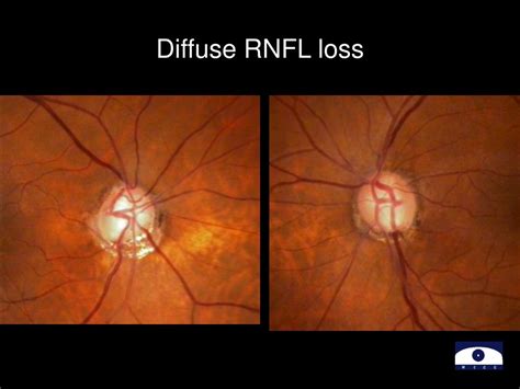 Ppt Optic Disc Evaluation In Glaucoma Powerpoint Presentation Free