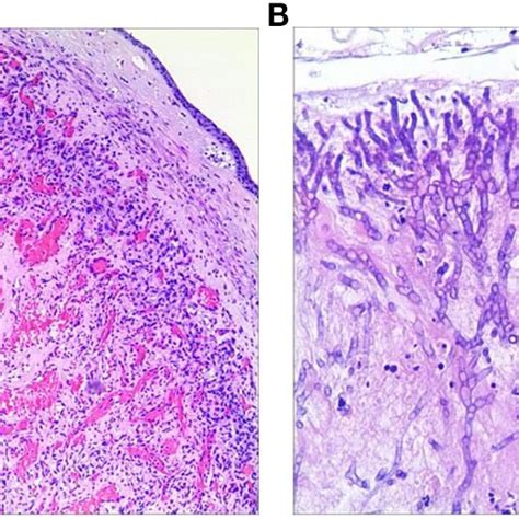 Histological Examination Of The Resected Specimen Revealed Capillary