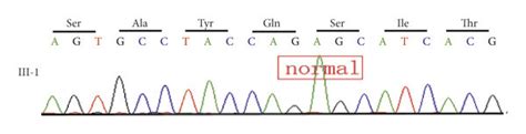 Sanger Sequencing DNA Chromatogram Of The Pedigree II 2 III 1 III 2