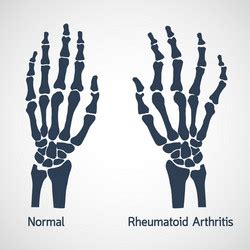 Rheumatoid Arthritis Icon Royalty Free Vector Image