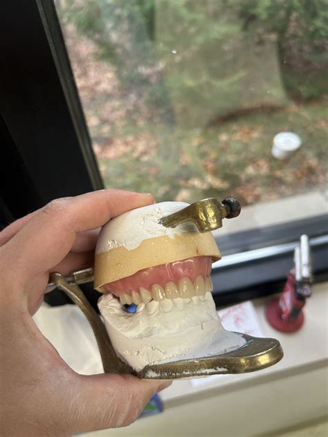 Assad Allah Al Zein On Linkedin Upper Complete Denture Try In