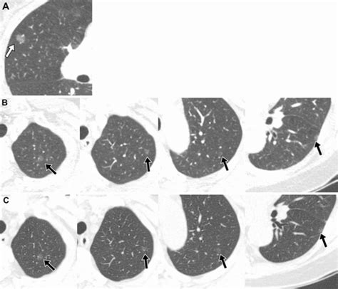 Prognostic Implications Of Synchronous Subsolid Nodules In Patients With Resected Subsolid Lung