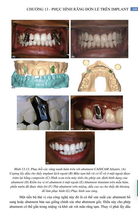 ChƯƠng 13 PhỤc HÌnh RĂng ĐƠn LẺ TrÊn Implant13