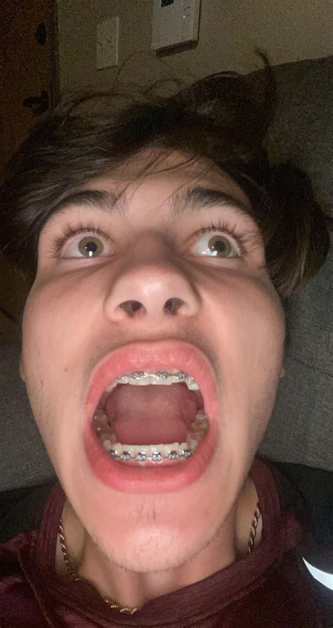 9 Month Progress Update R Braces