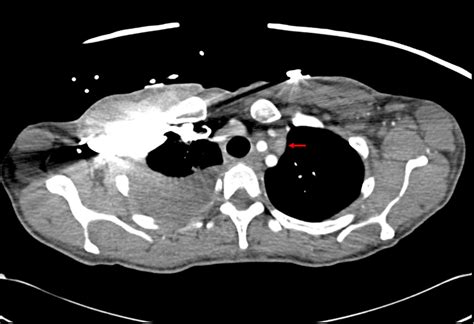 Recurrent Chylothorax A Clinical Mystery Bmj Case Reports