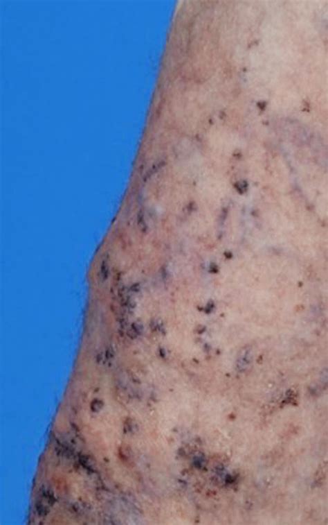 Compva Characteristics Of The Clinical Presentation — Capillary