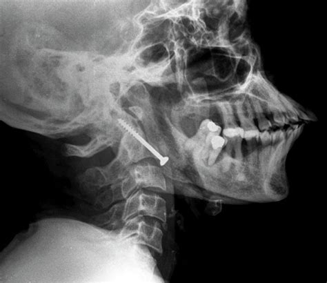 Dislocated Neck X Ray