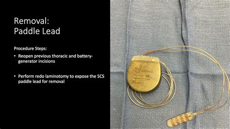 Surgical Removal Of Spinal Cord Stimulator Wire And Paddle Lead Extraction Youtube