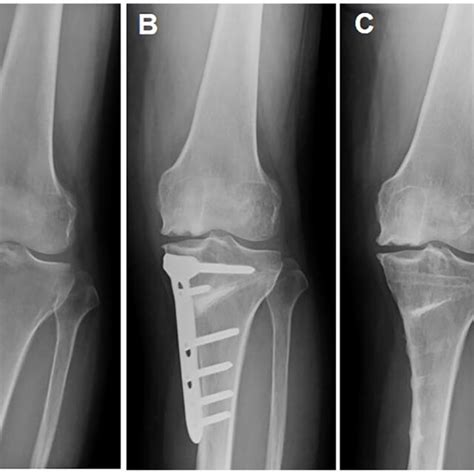 Radiographs Of A 72 Year Old Woman With Spontaneous Osteonecrosis Of