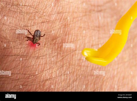 Removing A Tick From A Human Body With A Hook Ixod Persulcatus Man