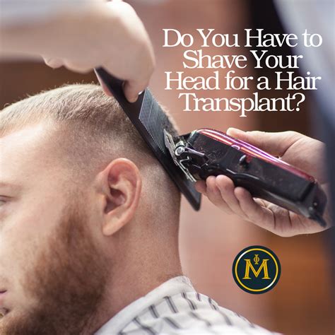 Do You Have To Shave Your Head For A Hair Transplant