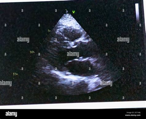 Echocardiography Or Cardiac Ultrasound Shows Normal Values Except For Left Ventricular