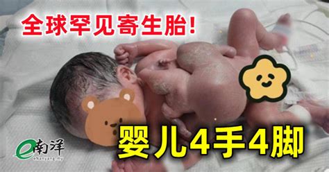 全球罕见寄生胎 深圳婴儿4手4脚